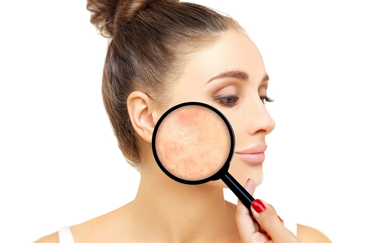 Everything You Need to Know About Atrophic Scars | Vargas Face & Skin ...