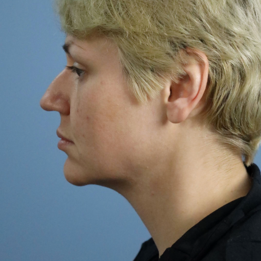 Types of Atrophic Scarring: How They Differ and How to Treat Them ...