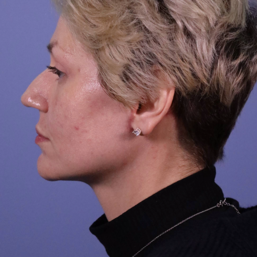 Unpacking Eye Bags: What Causes Them and How To Get Rid of Them ...