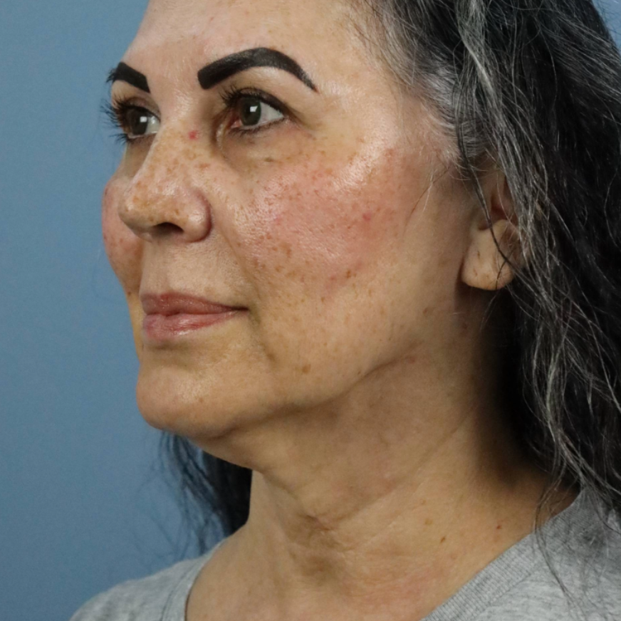 Types of Atrophic Scarring: How They Differ and How to Treat Them ...