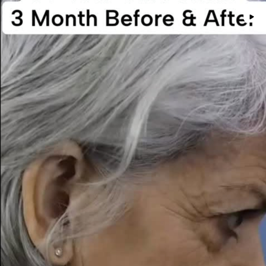 Unpacking Eye Bags: What Causes Them and How To Get Rid of Them ...